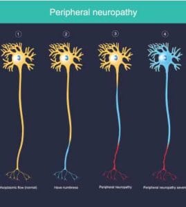 Vibration Therapy for Peripheral Neuropathy - Neuropathy Relief Pain Miami